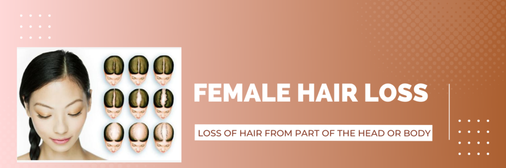 Female Hair Loss: Causes, Symptoms & Treatment | USHC