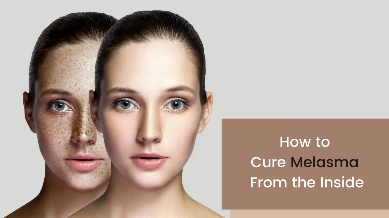 How to Cure Melasma From the Inside? - Urban Skin and Hair Clinic
