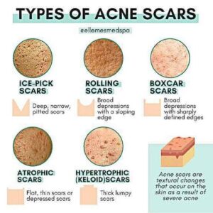 Acne Scars: Causes, Symptoms & Treatment | USHC