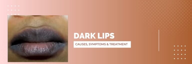 Dark Lips Types, Causes, Symptoms & Treatment