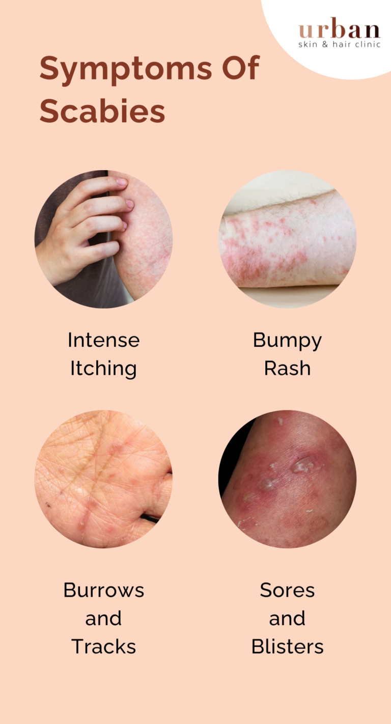 Scabies Types Causes Symptoms And Treatment Urban Skin And Hair Clinic