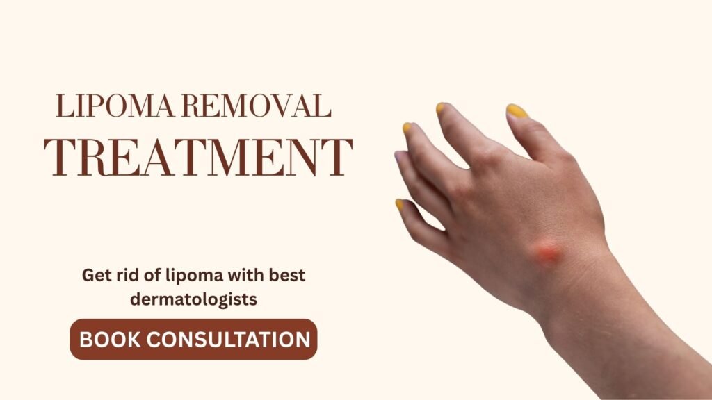 Lipoma Removal Treatment in India [Clinic] | USHC