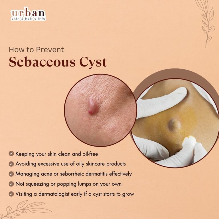 Sebaceous Cyst Removal Treatment in India [Clinic ] | USHC