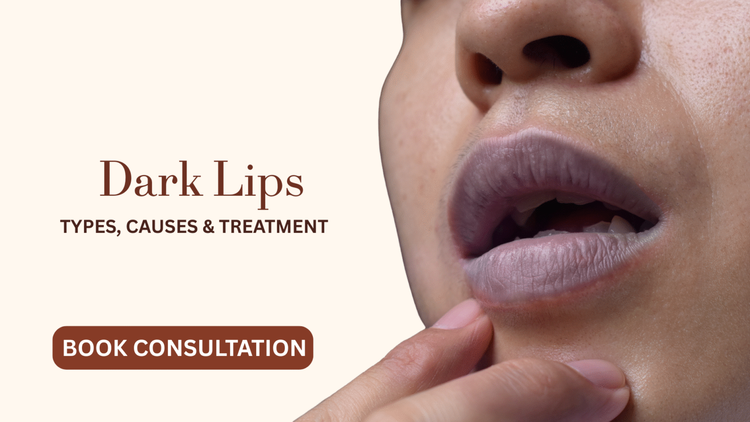Dark Lips Types, Causes, Symptoms & Treatment