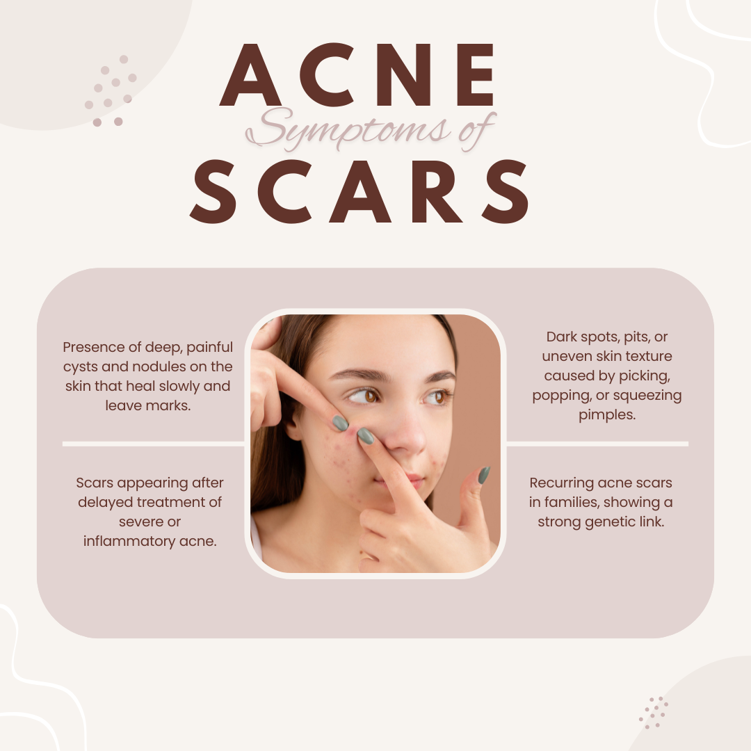Best Acne Scars Treatment : Causes, Symptoms And Treatment 2026