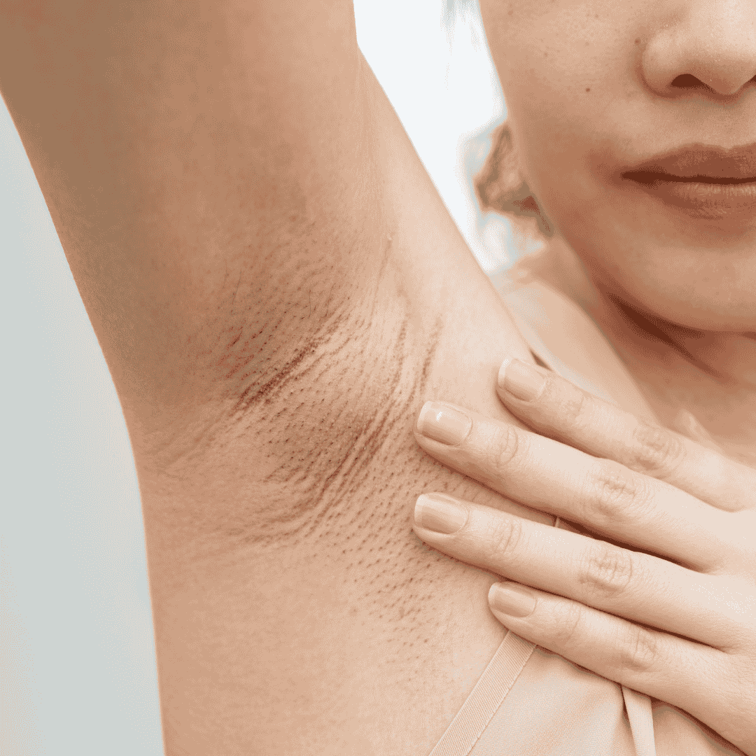 Dark Underarms Causes Type Symptoms And Treatment Ushc