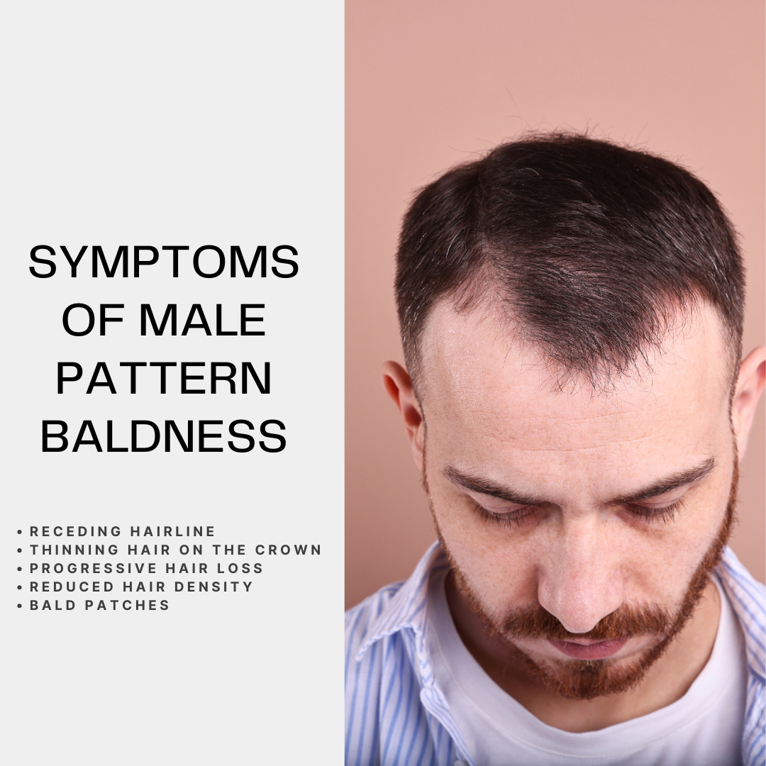 Male Pattern Baldness Types, Causes Signs & Treatment | USHC