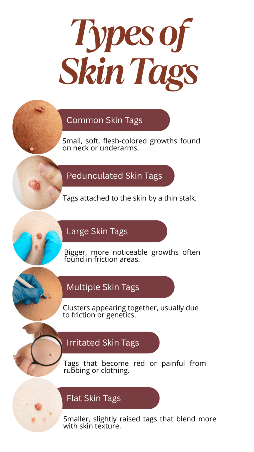 Best Skin Tag Removal Treatment in India - USHC