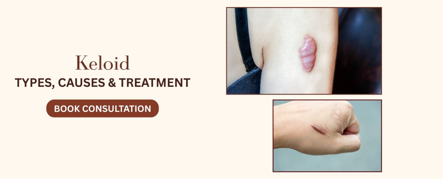 Keloid Types, Causes, Symptoms & Treatment | USHC