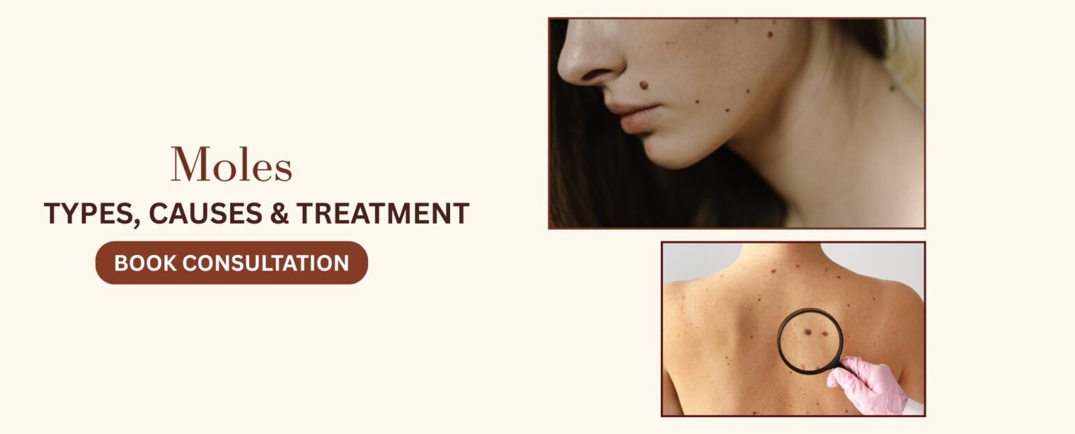 Moles Types, Causes, Symptoms & Treatment