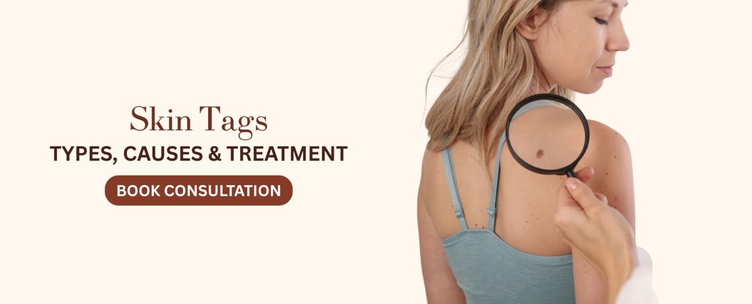 Skin tags Types, Causes, Symptoms & Treatment