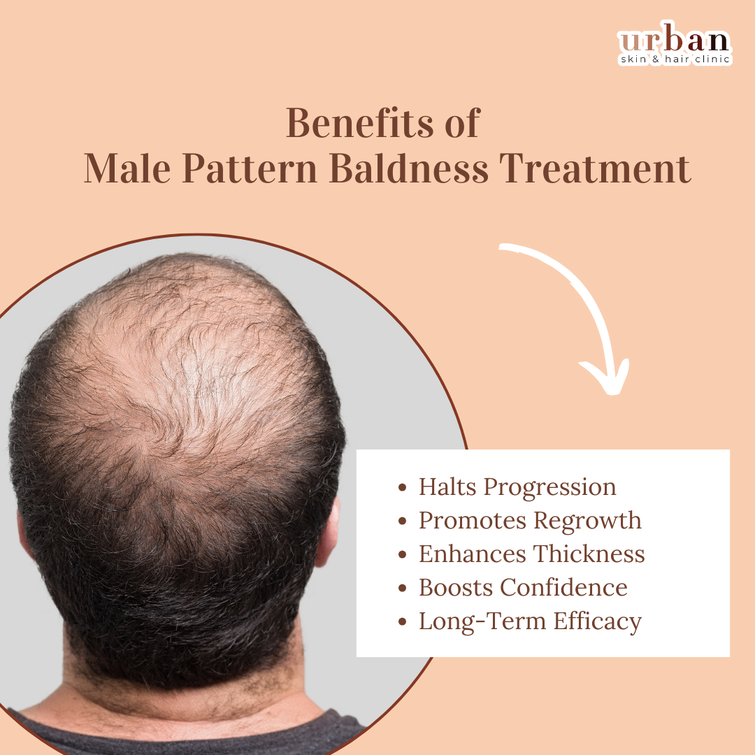 Male Pattern Baldness Types, Causes Signs & Treatment | USHC