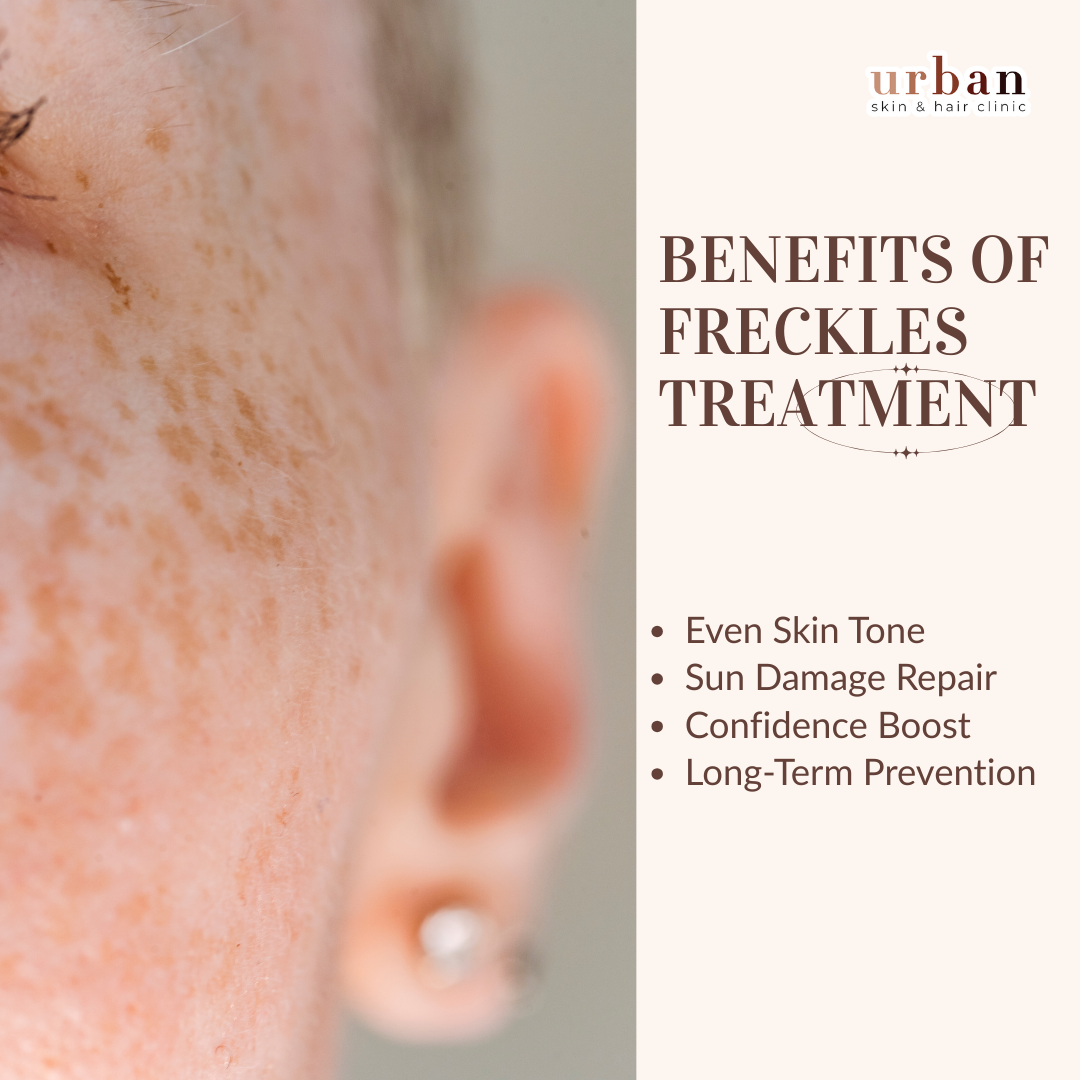 Freckles Types, Causes, Symptoms & Treatment | 2026