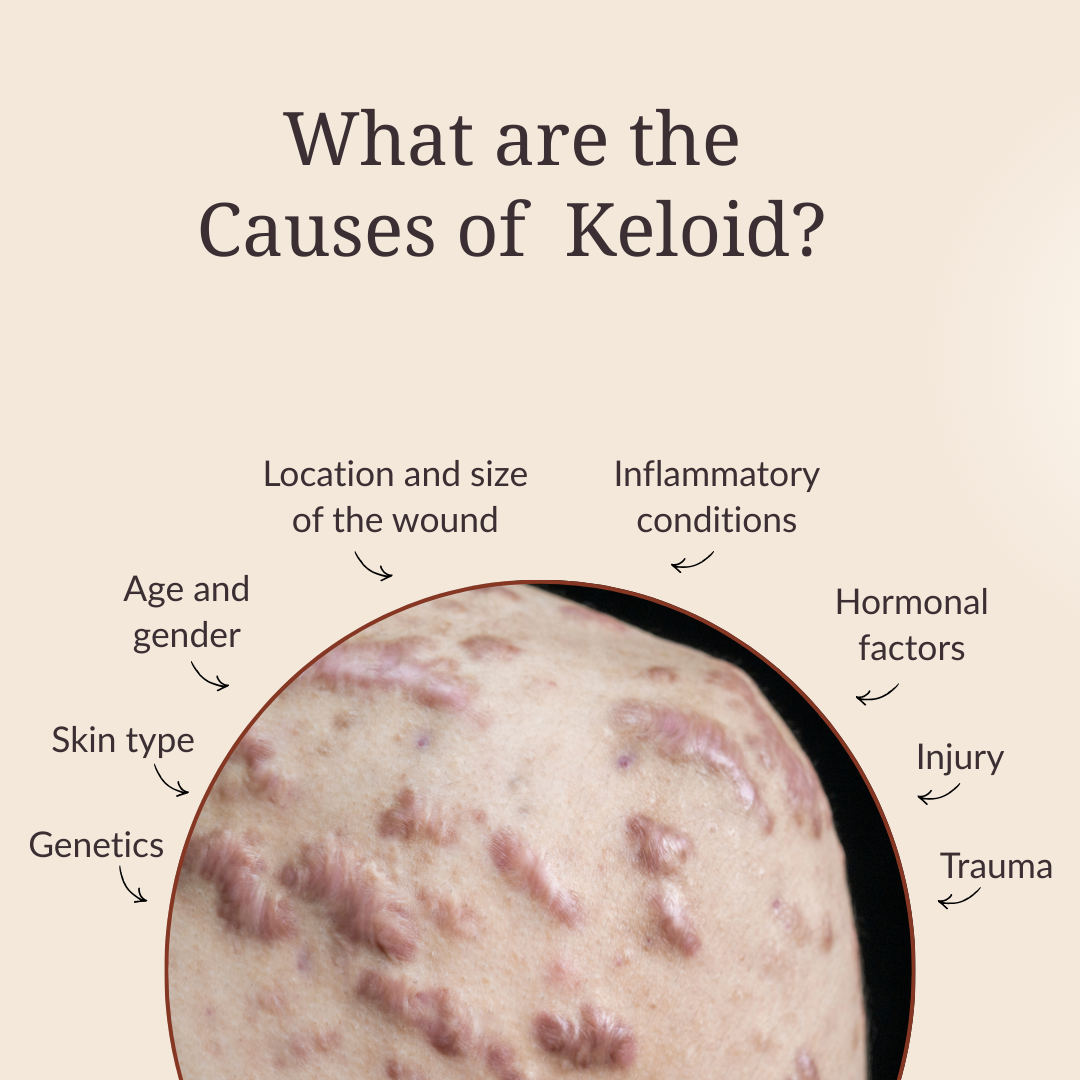 Keloid Types, Causes, Symptoms & Treatment | USHC