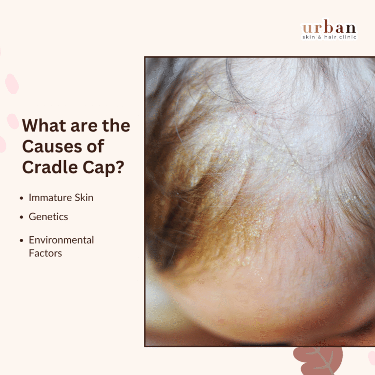 Cradle Cap Types, Causes, Symptoms & Treatment - Urban Skin and Hair Clinic