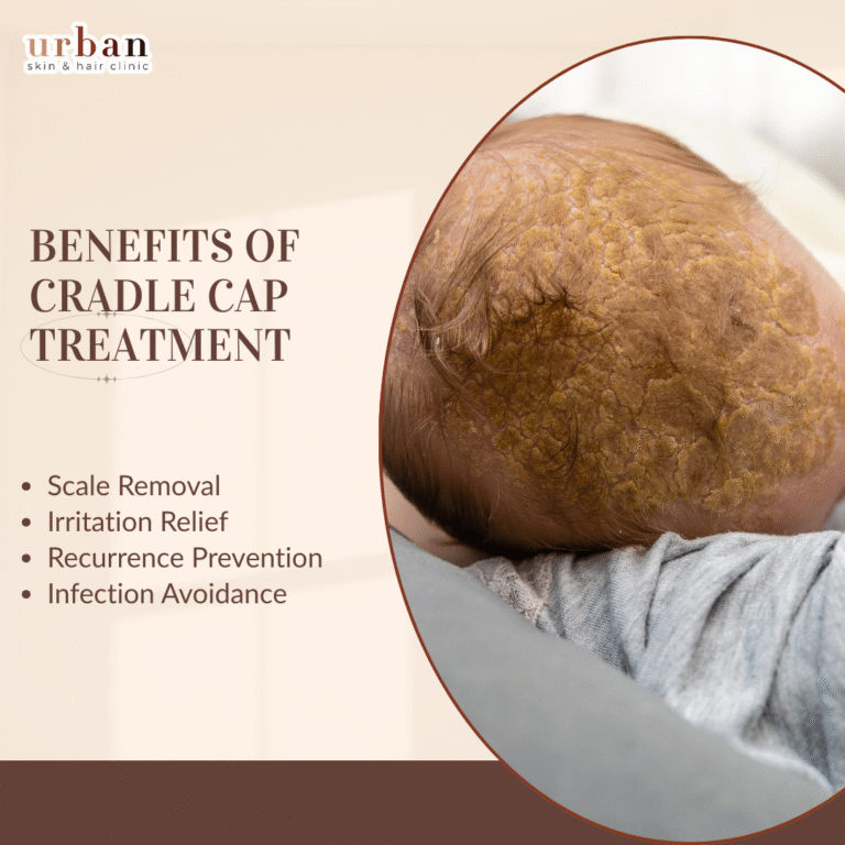 Cradle Cap Types, Causes, Symptoms & Treatment - Urban Skin and Hair Clinic