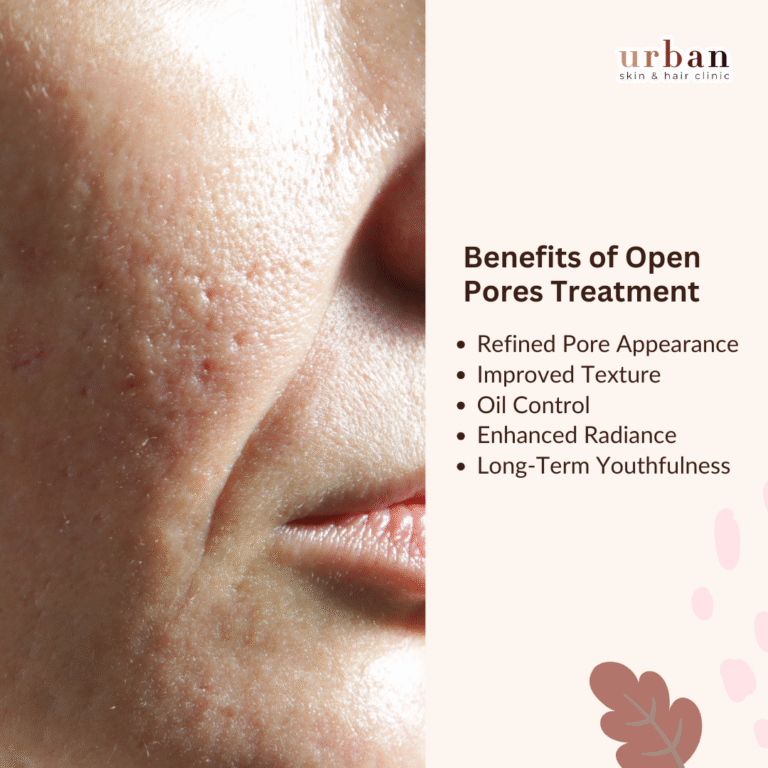 Open Pores Types, Causes, Symptoms & Treatment